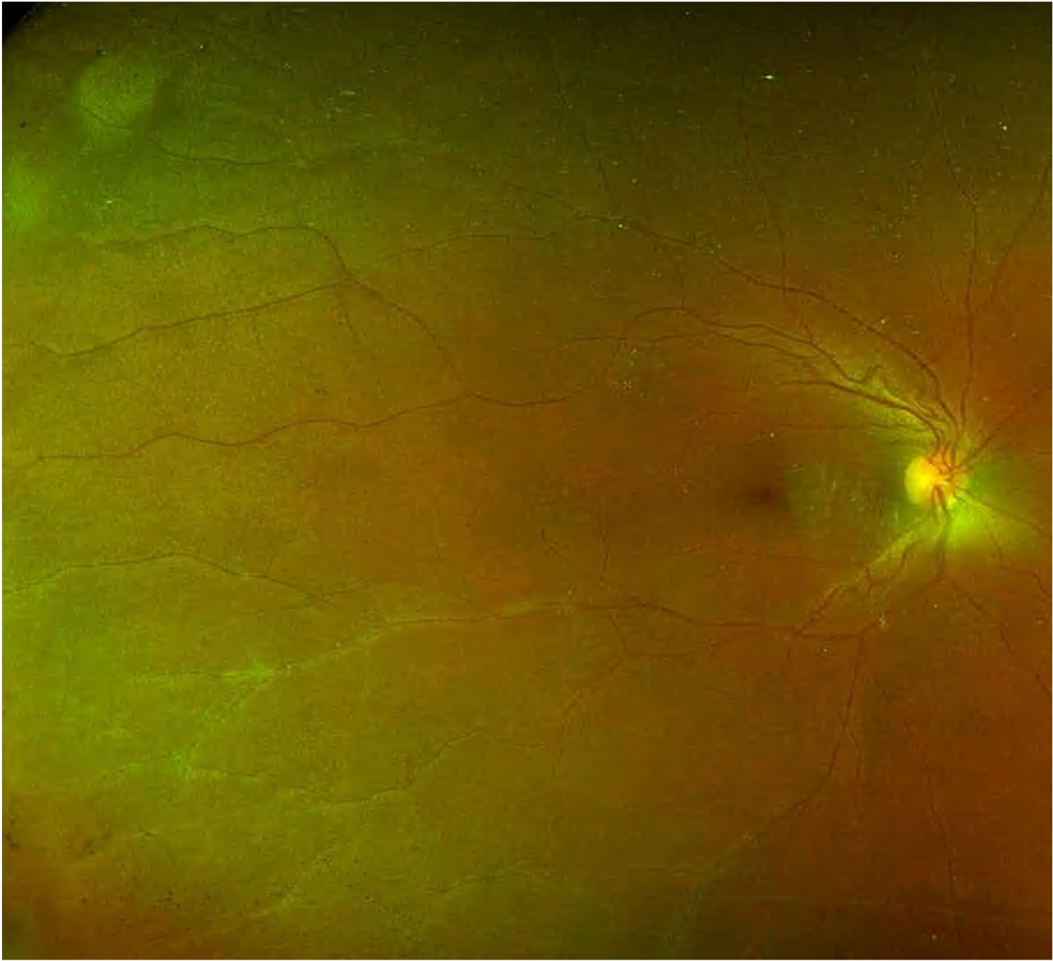 Intermediate uveitis | Viewpoint