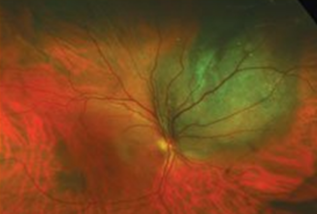 Choroidal melanoma | Viewpoint