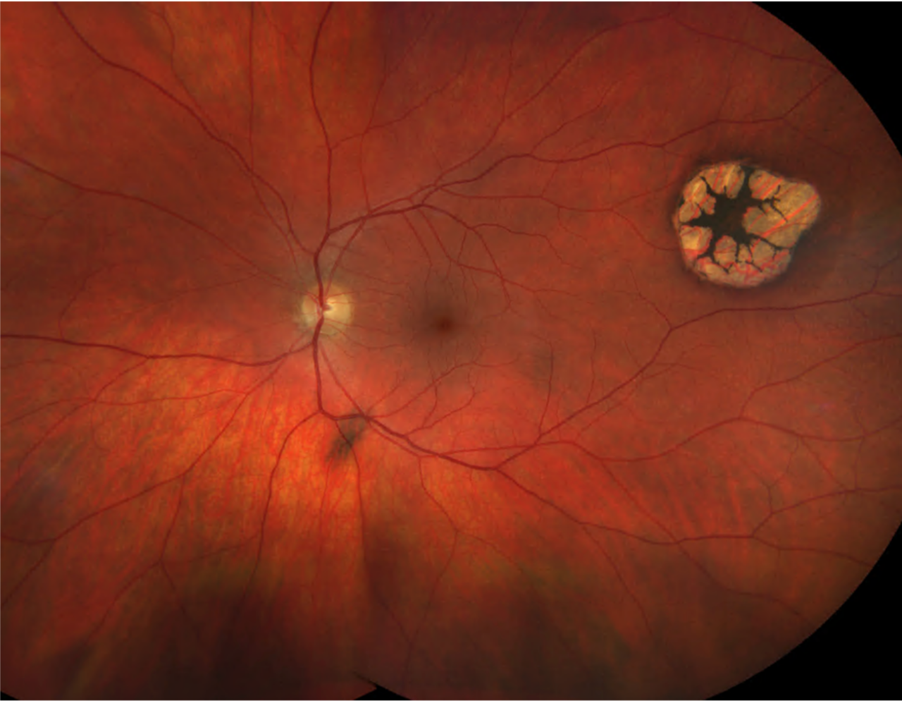 Benign chorioretinal lesions | Viewpoint