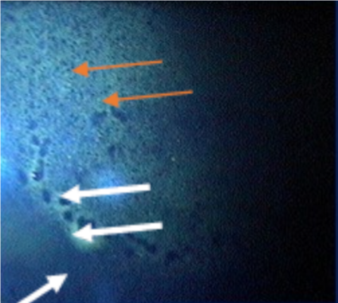 Bullous keratopathy | Viewpoint