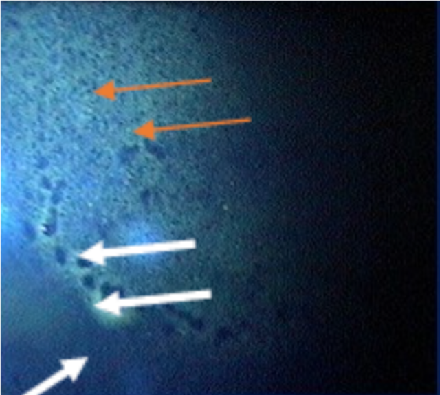 Bullous keratopathy | Viewpoint