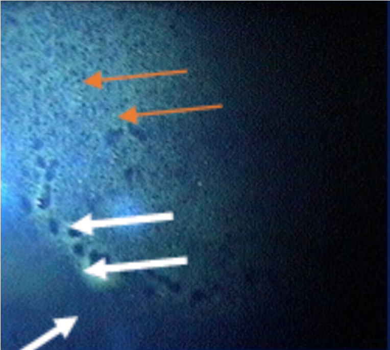 Bullous keratopathy | Viewpoint