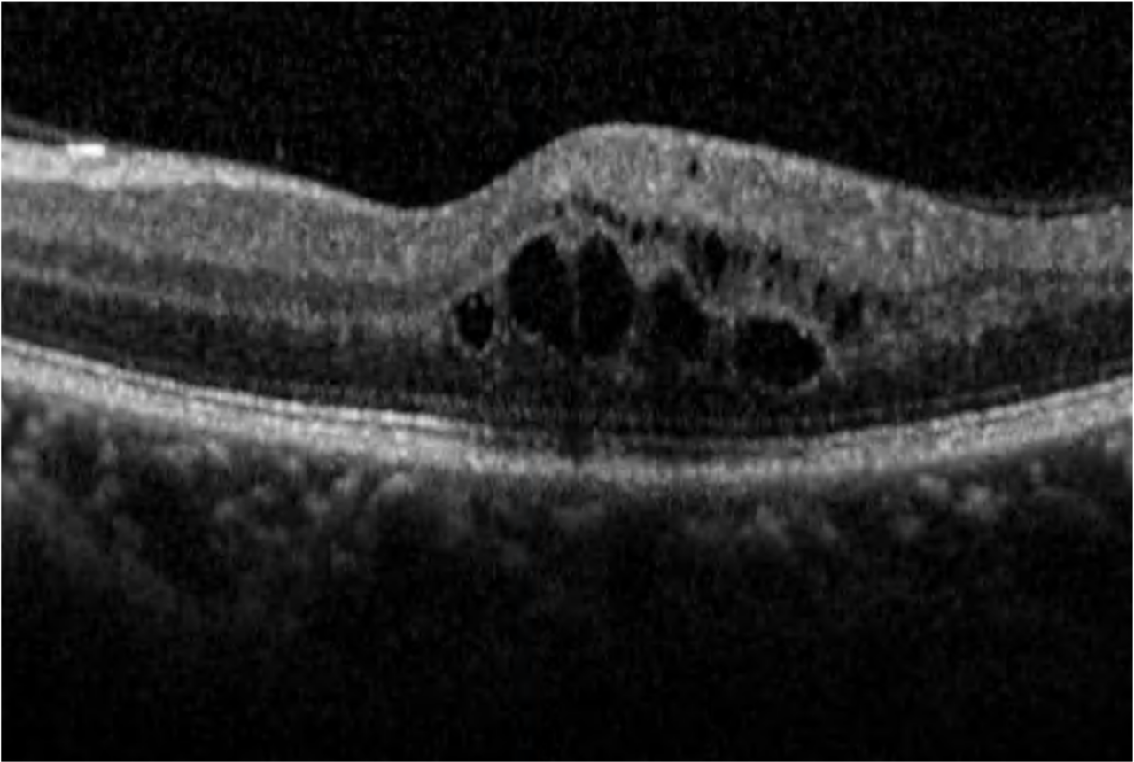 Intermediate uveitis | Viewpoint