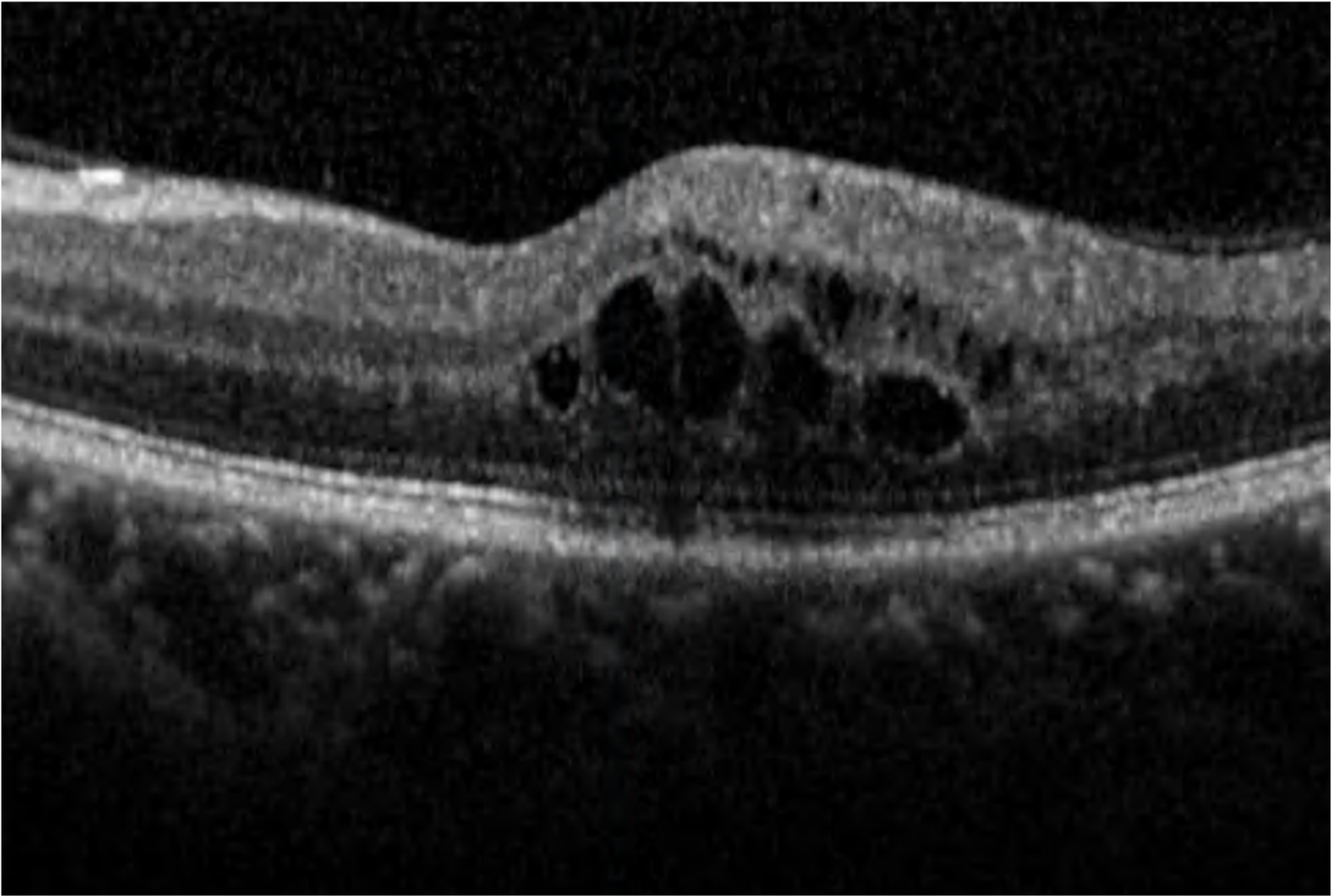 Intermediate uveitis | Viewpoint