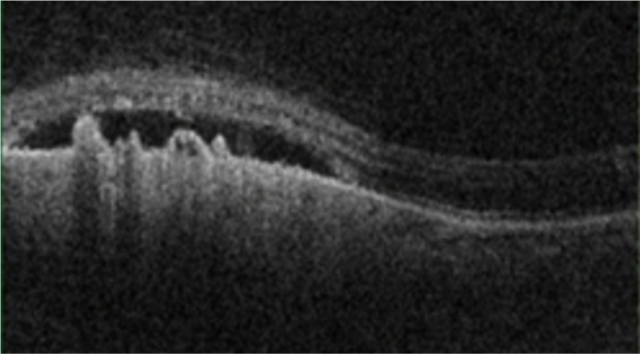Choroidal nevus | Viewpoint