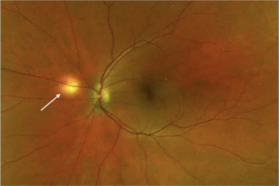 Benign chorioretinal lesions | Viewpoint