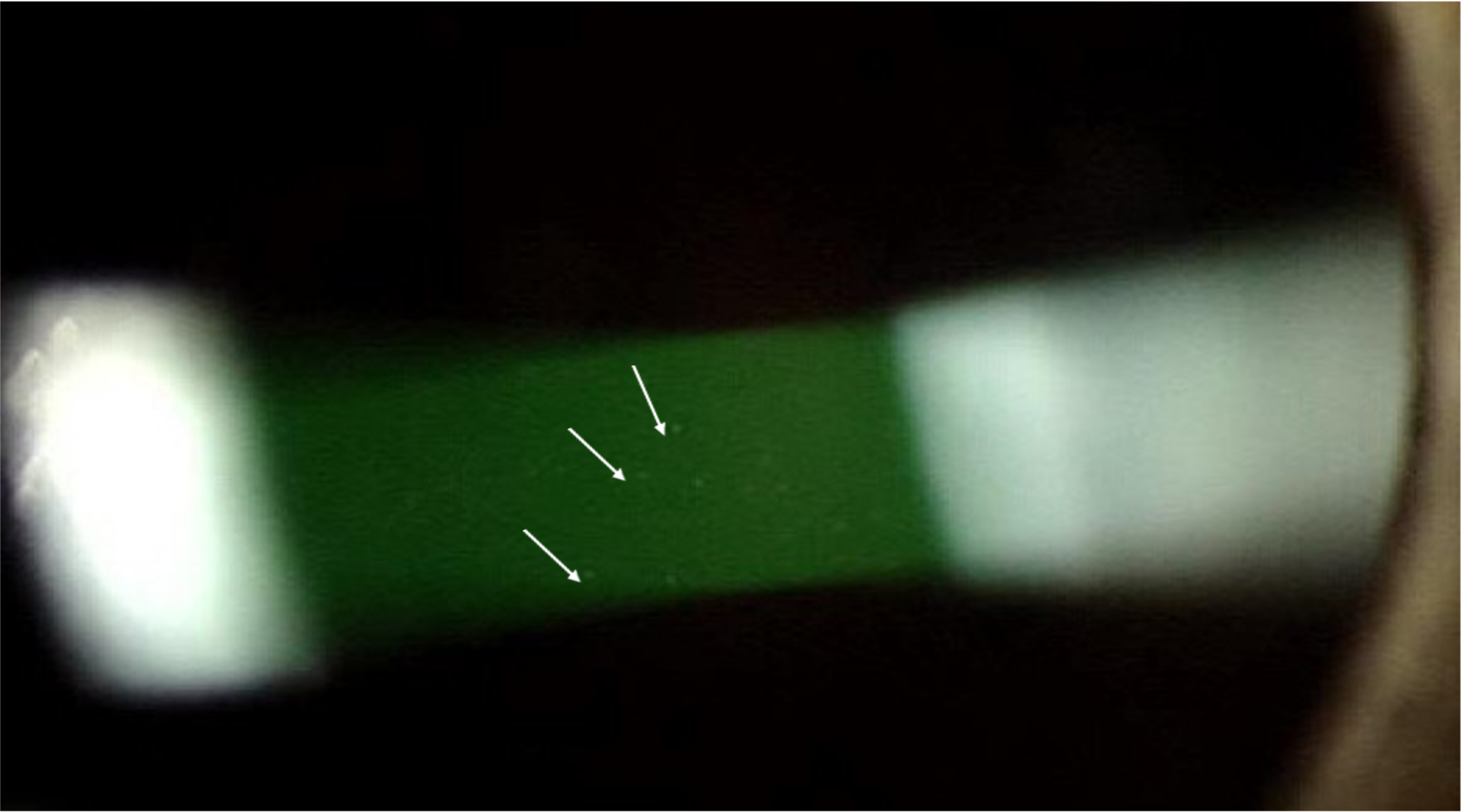 Anterior uveitis | Viewpoint