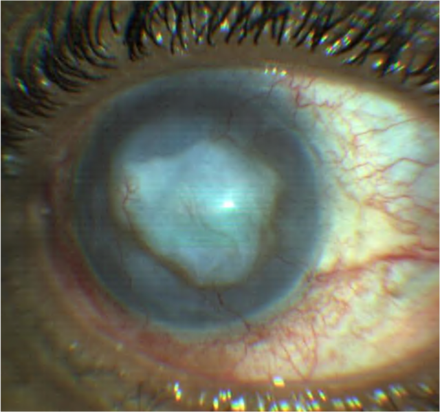 Bullous keratopathy | Viewpoint