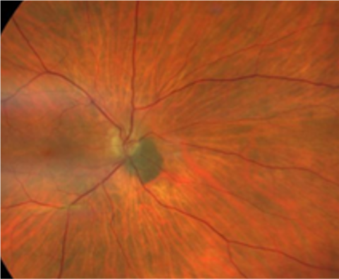 Choroidal nevus | Viewpoint