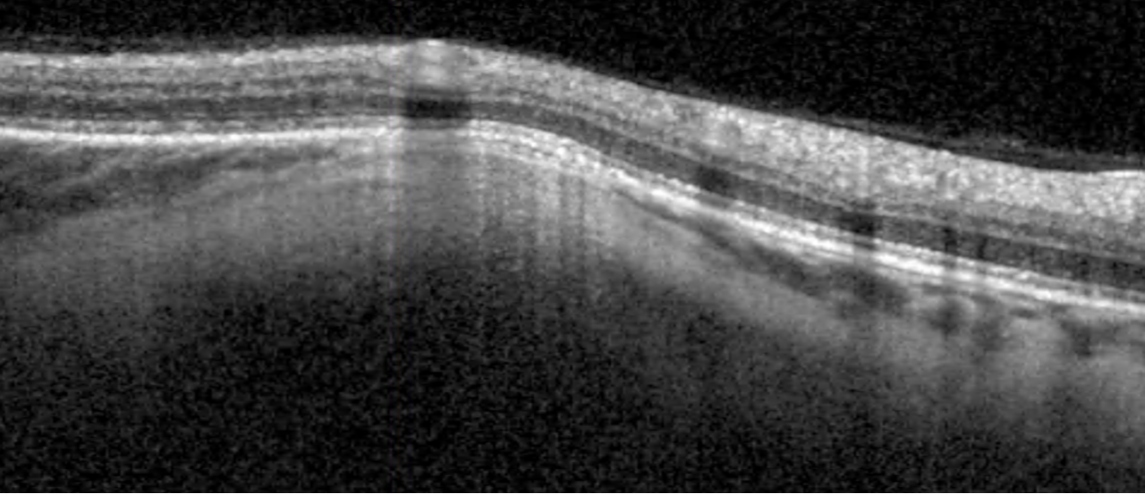 Benign chorioretinal lesions | Viewpoint
