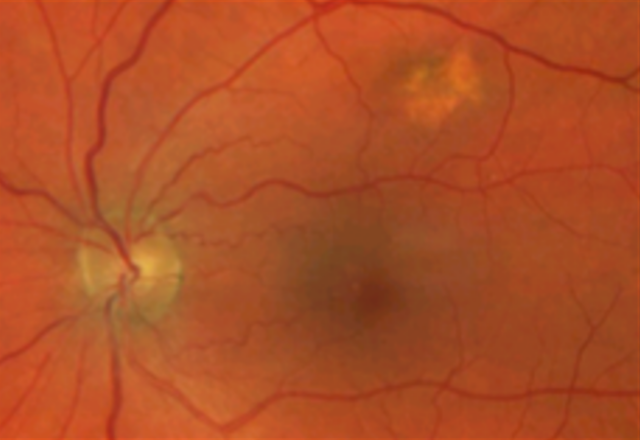 Choroidal nevus | Viewpoint