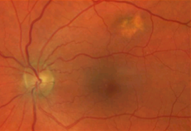 Choroidal nevus | Viewpoint