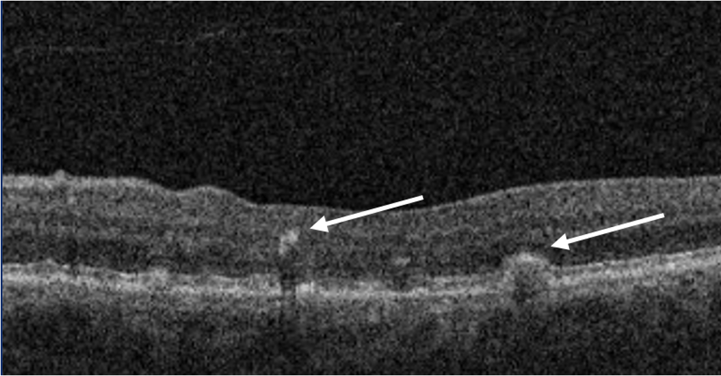Age-related macular degeneration | Viewpoint