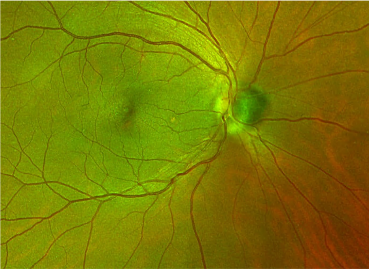 Benign chorioretinal lesions | Viewpoint