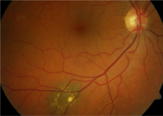 Choroidal melanoma | Viewpoint