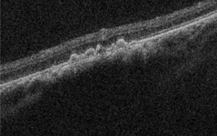 Choroidal nevus | Viewpoint