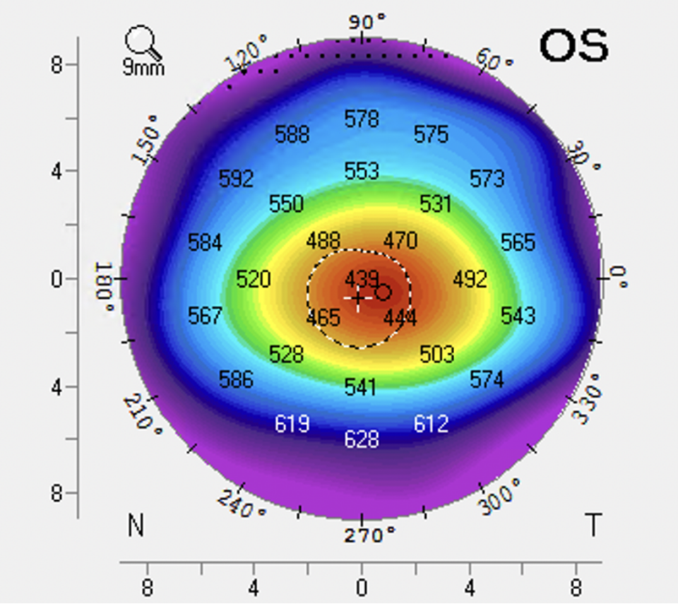 Keratoconus and corneal ectasia | Viewpoint