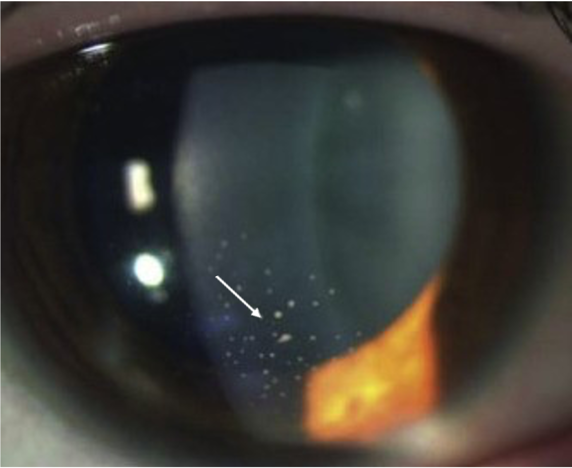 Anterior uveitis | Viewpoint