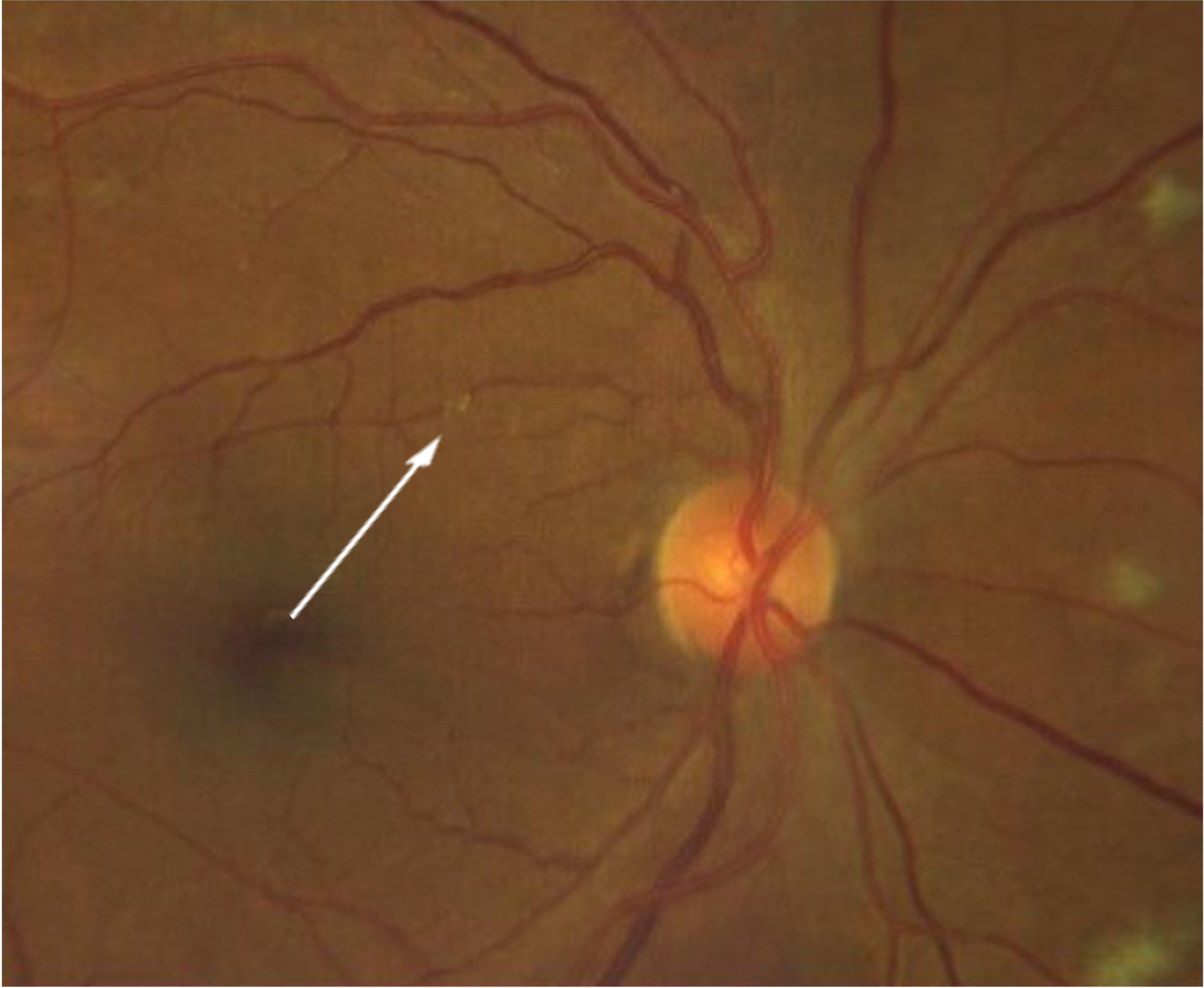 Retinal artery occlusion | Viewpoint