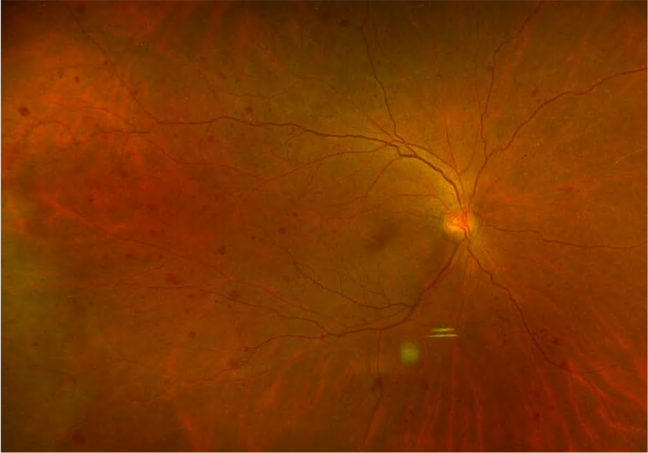 Neovascular glaucoma | Viewpoint