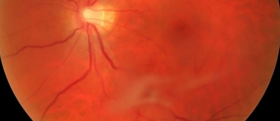 Posterior vitreous detachment | Viewpoint