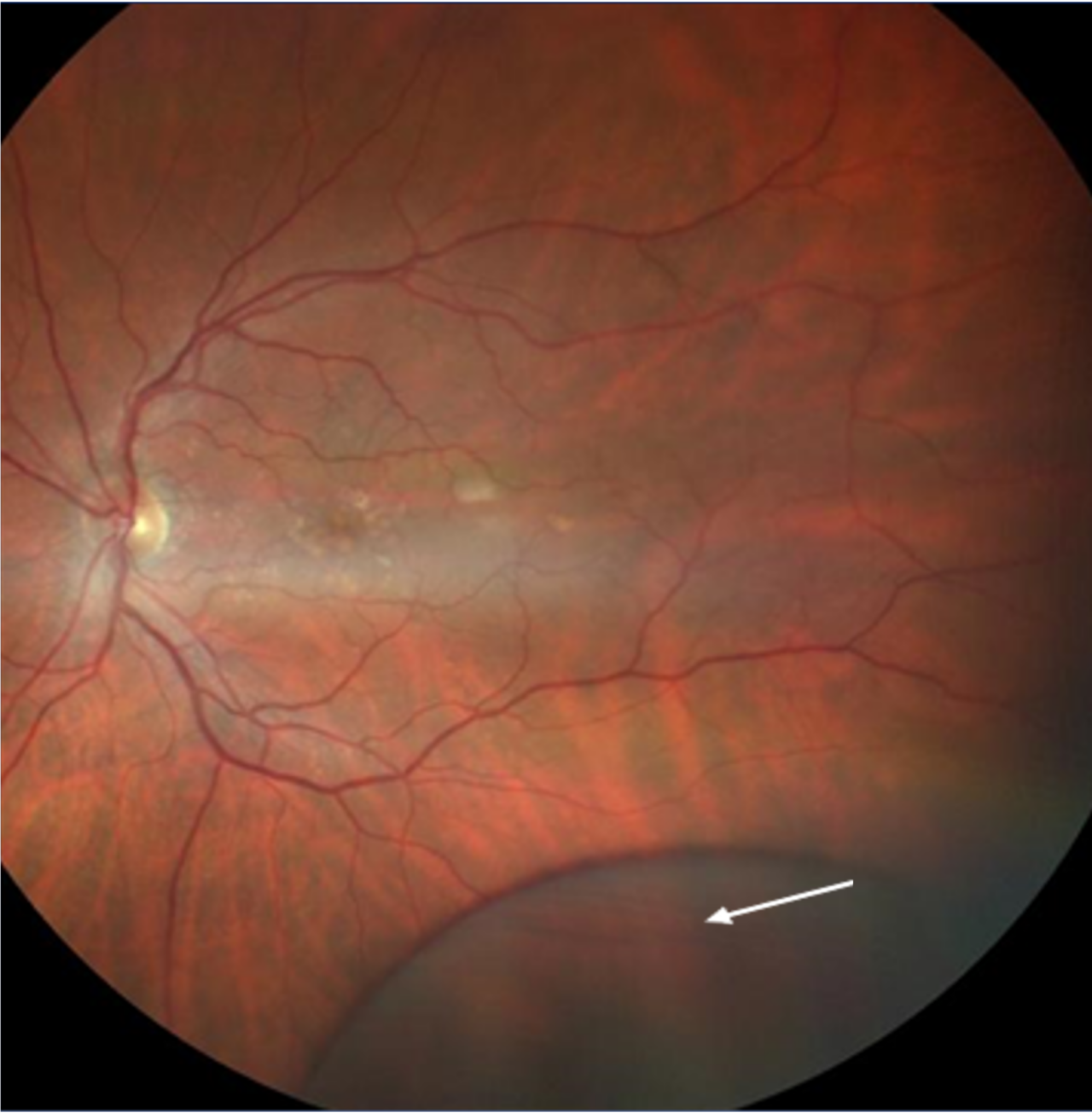 Peripheral myopic degenerations and myopic choroidal neovascularisation ...