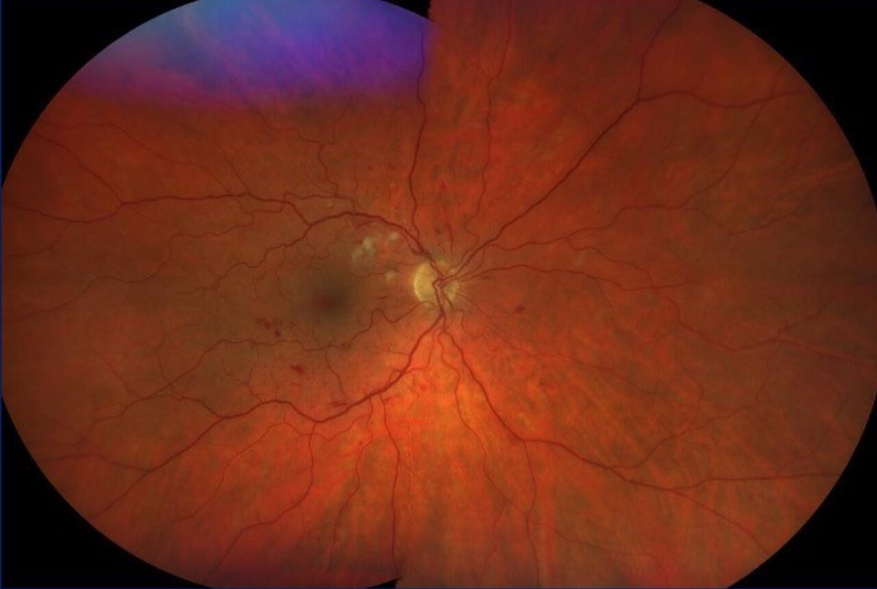 Hypertensive retinopathy | Viewpoint