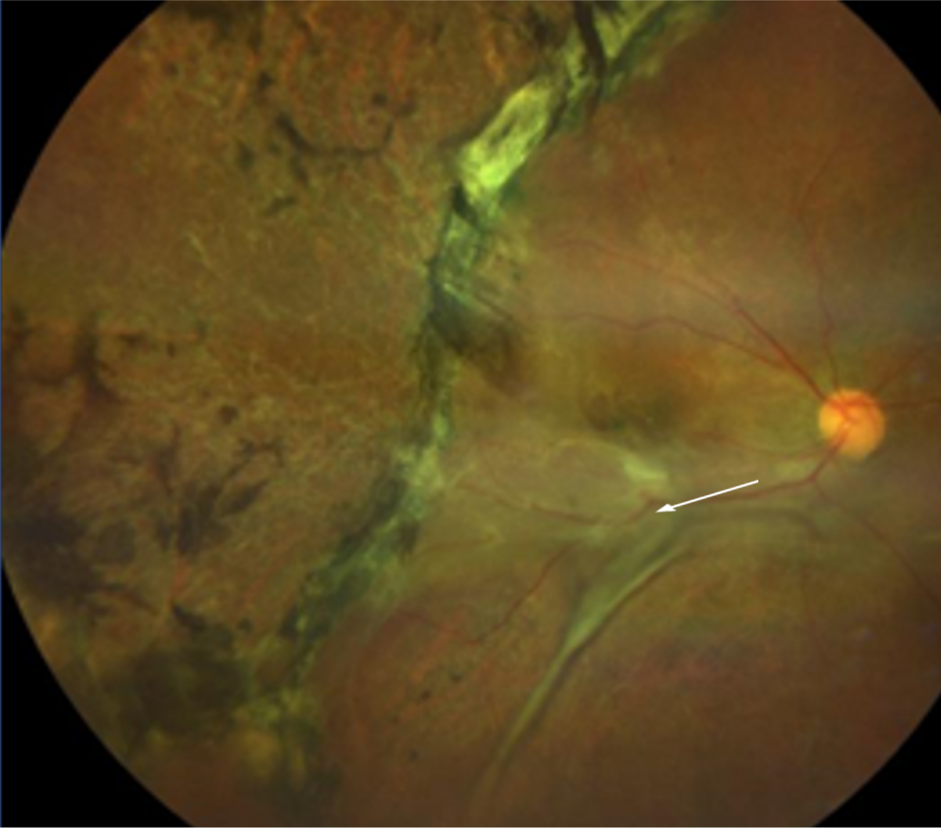 Tractional and exudative retinal detachment | Viewpoint