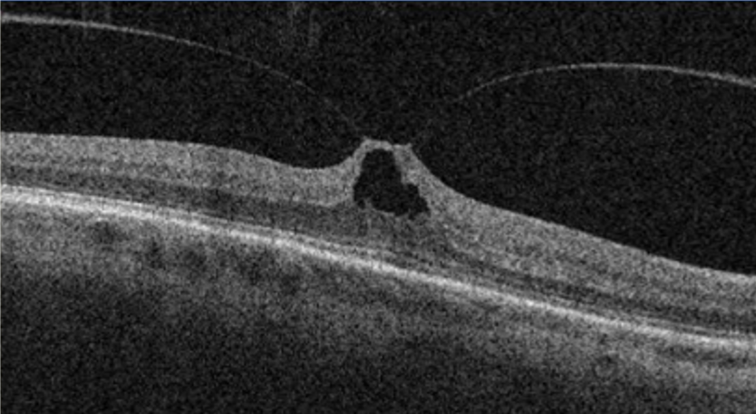 Vitreoretinal surface diseases | Viewpoint