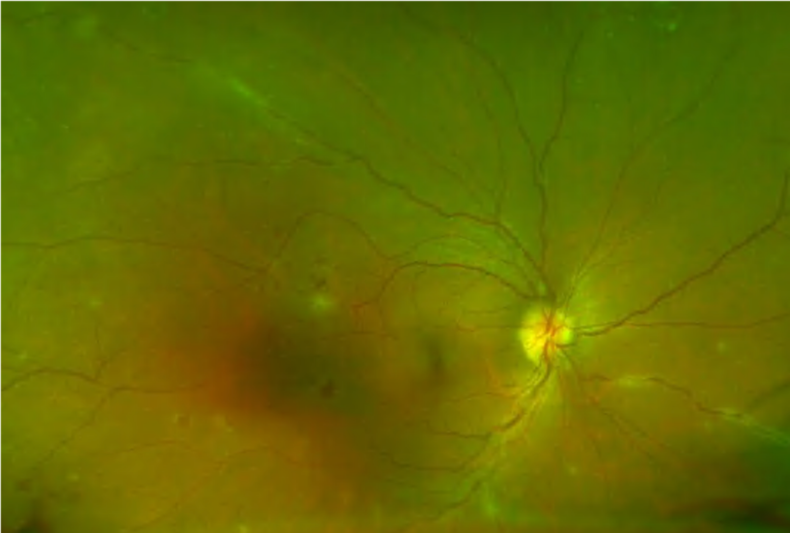 Posterior Uveitis And Panuveitis Viewpoint