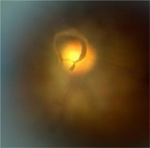 Posterior vitreous detachment | Viewpoint