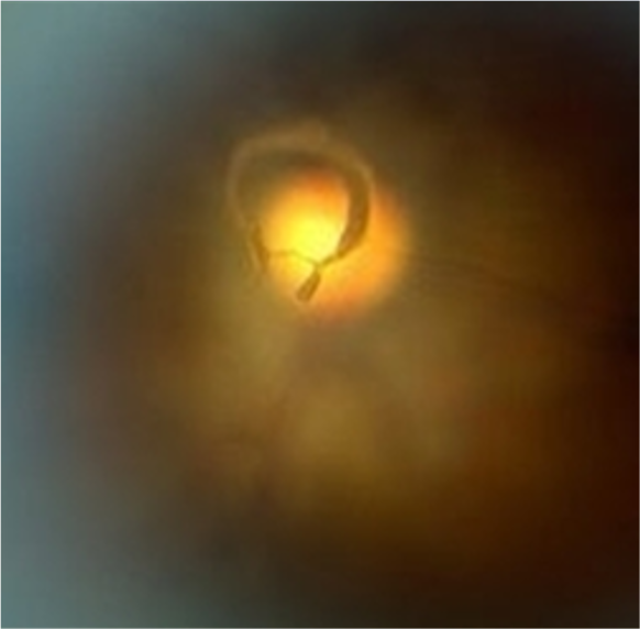 Posterior vitreous detachment | Viewpoint