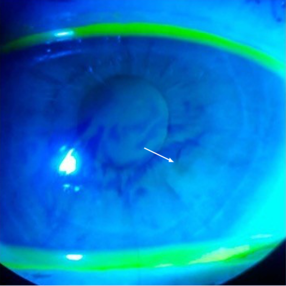 Dry eye disease | Viewpoint