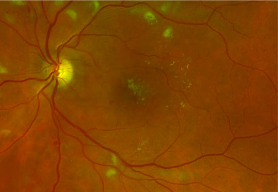 Diabetic macular oedema | Viewpoint