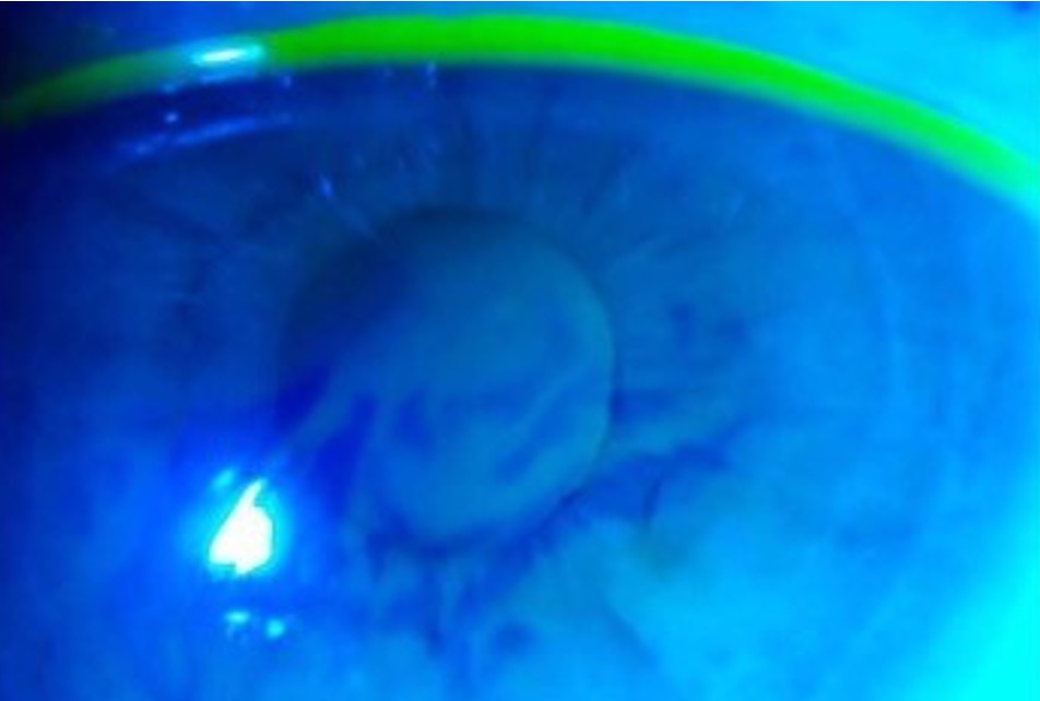 Dry eye disease | Viewpoint