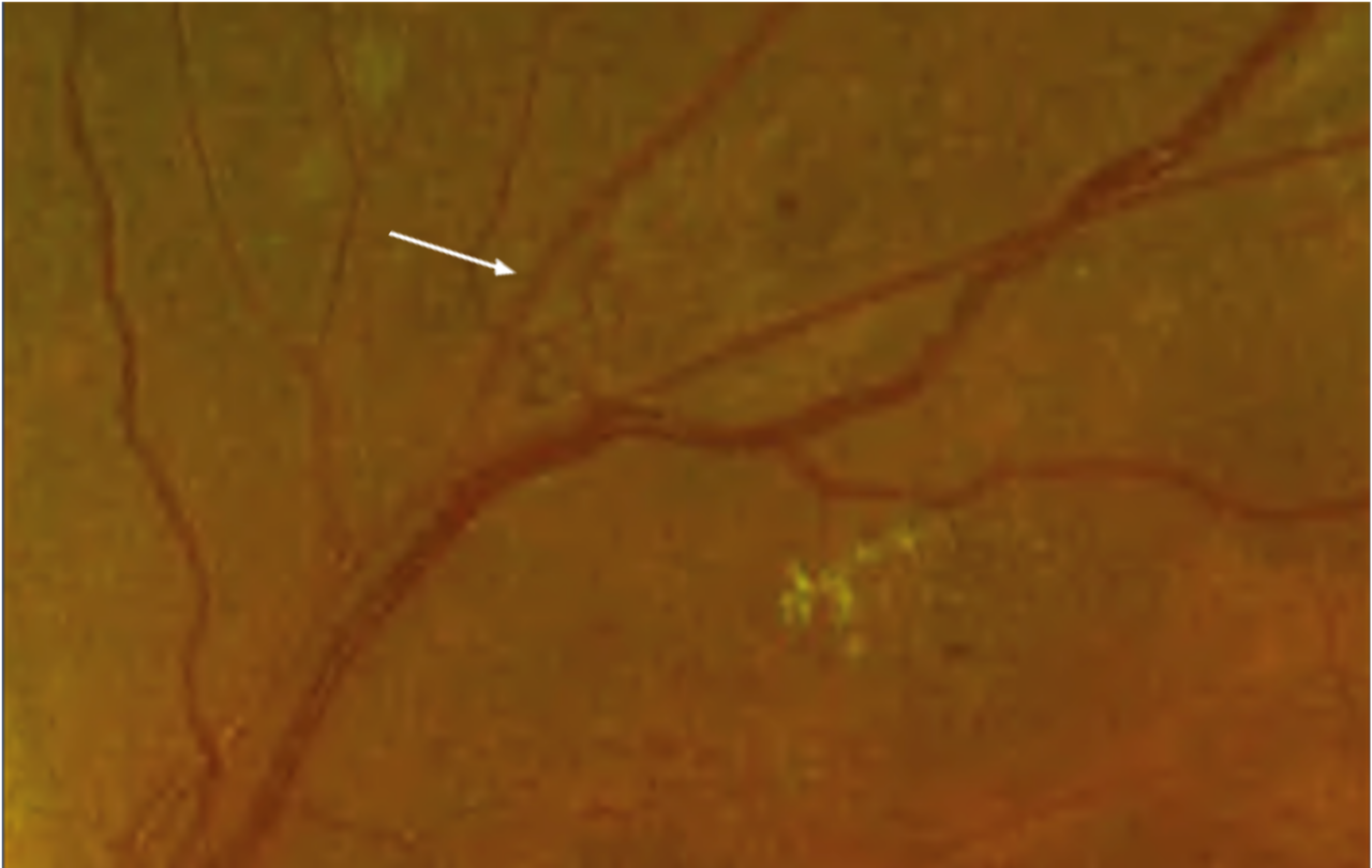 Diabetic retinopathy | Viewpoint