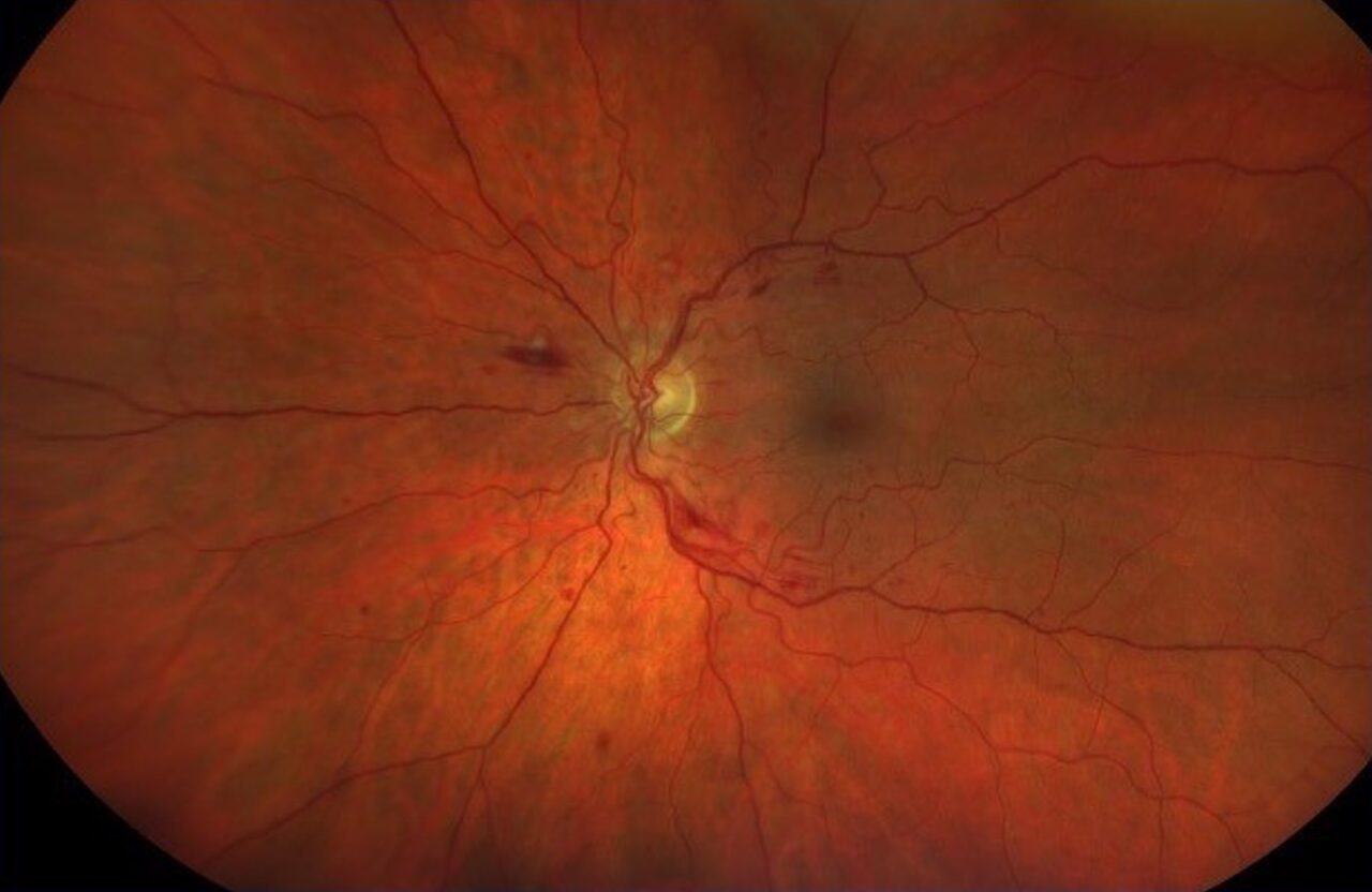 Hypertensive retinopathy | Viewpoint