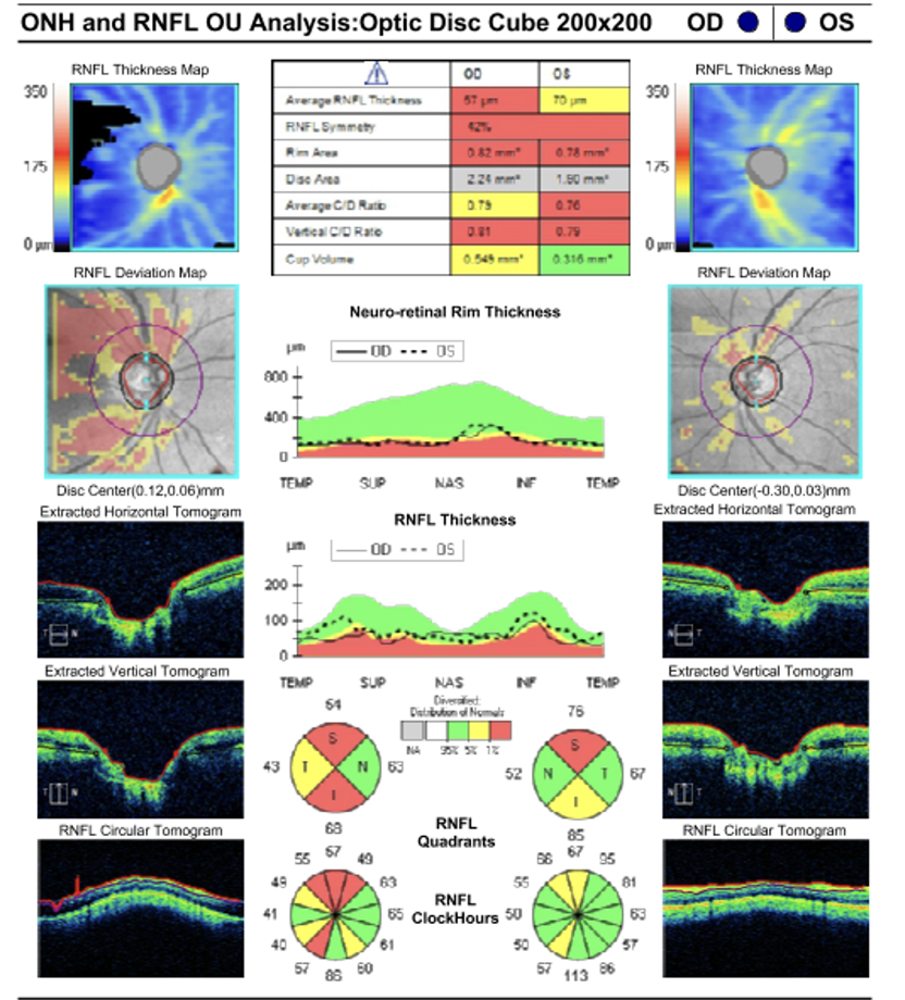 Primary and secondary open-angle glaucoma | Viewpoint