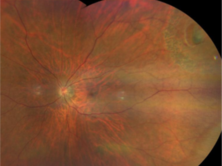 Rhegmatogenous retinal detachment | Viewpoint