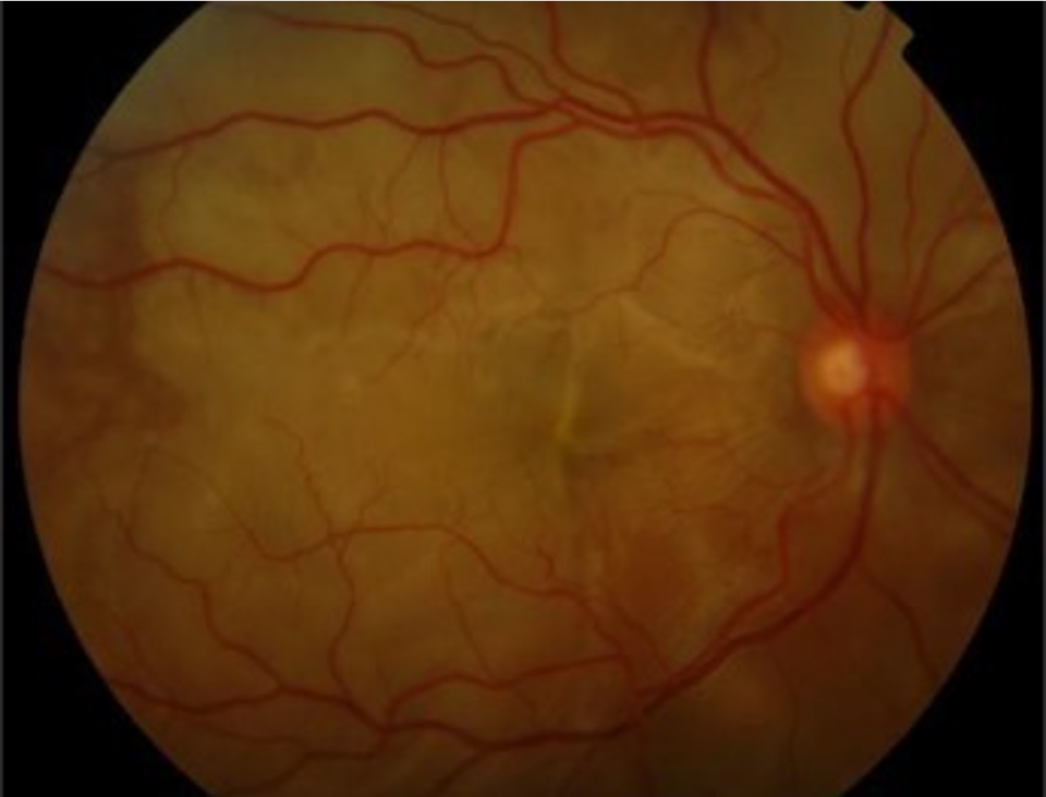 Tractional and exudative retinal detachment | Viewpoint