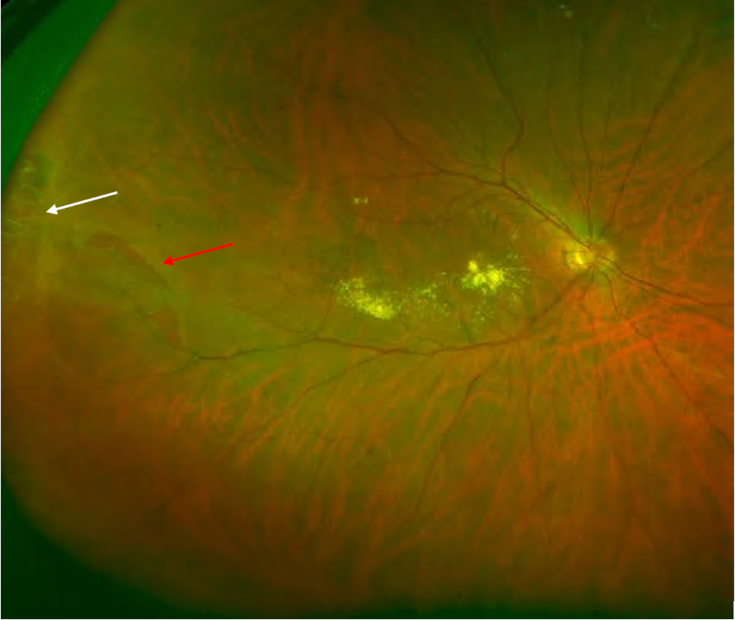 Peripheral myopic degenerations and myopic choroidal neovascularisation ...