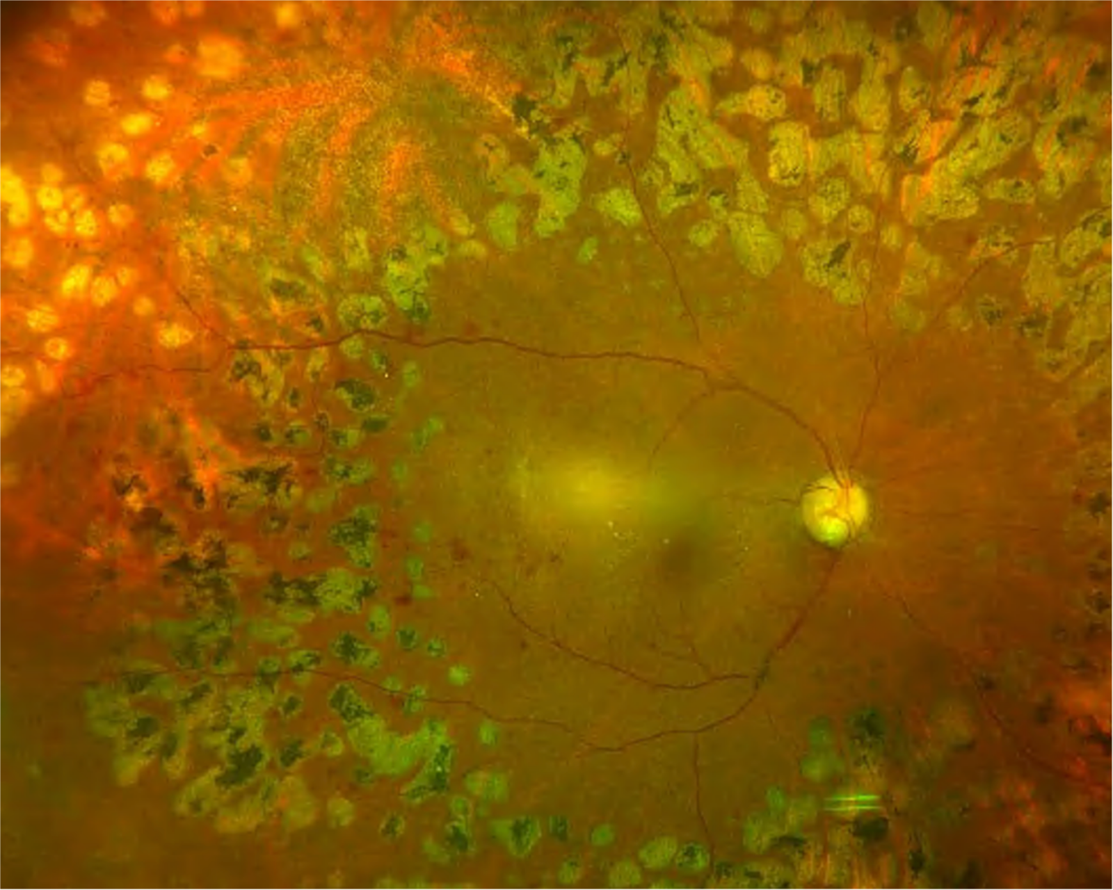 Neovascular glaucoma | Viewpoint