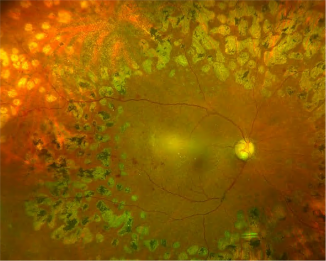 Neovascular glaucoma | Viewpoint