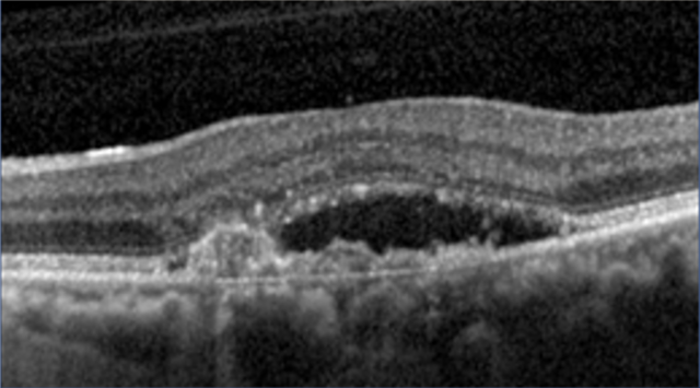 Neovascular age-related macular degeneration | Viewpoint