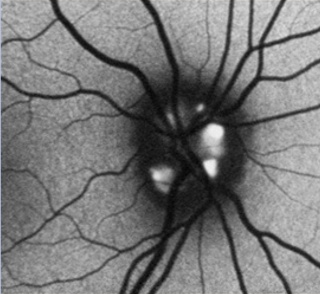Optic disc drusen | Viewpoint