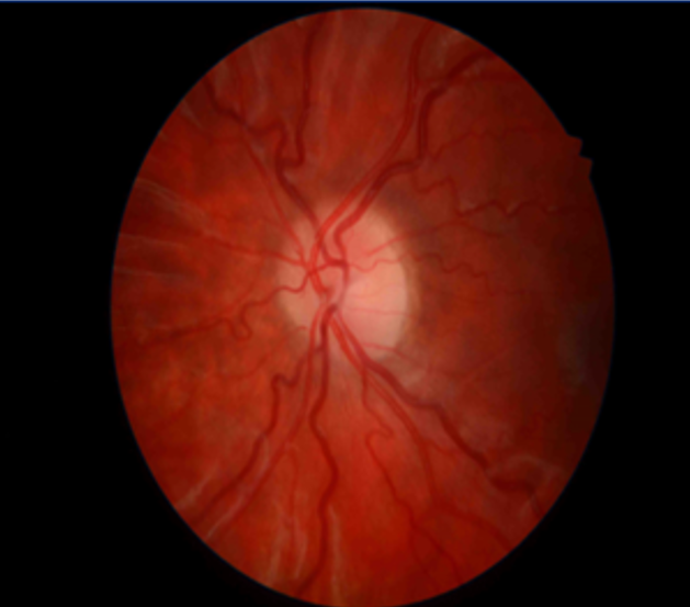 Normal Optic Nerve Vs Papilledema