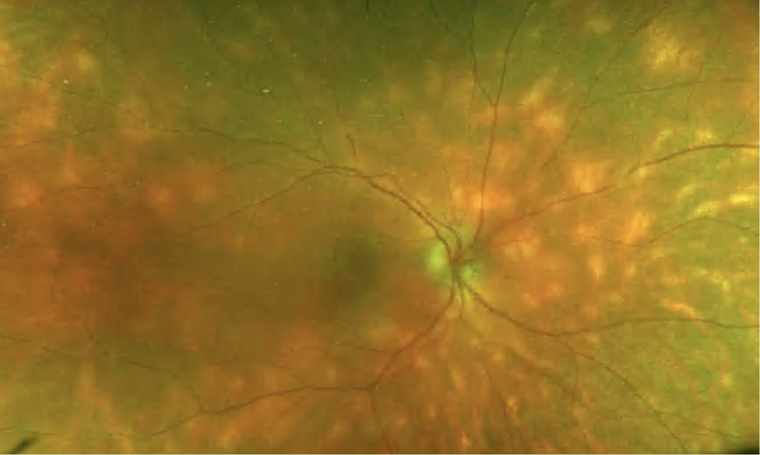 Posterior uveitis and panuveitis | Viewpoint