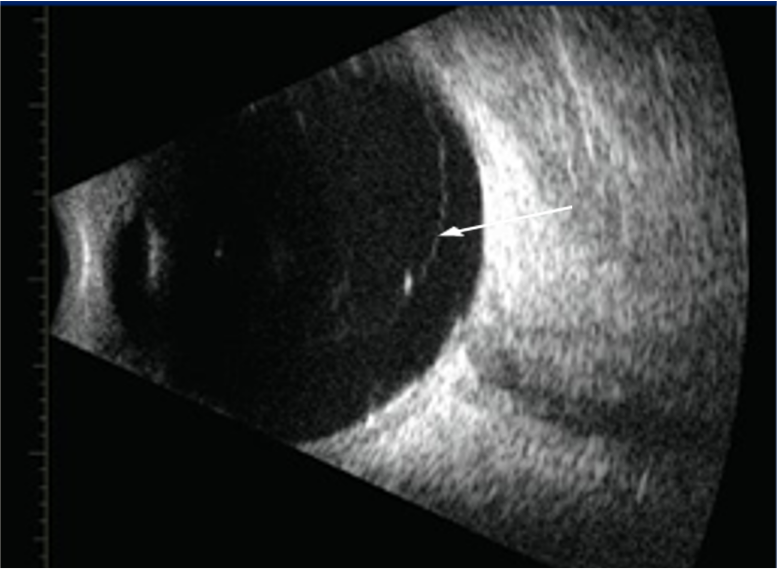 Posterior vitreous detachment | Viewpoint