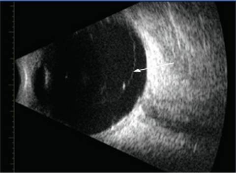 Posterior vitreous detachment | Viewpoint