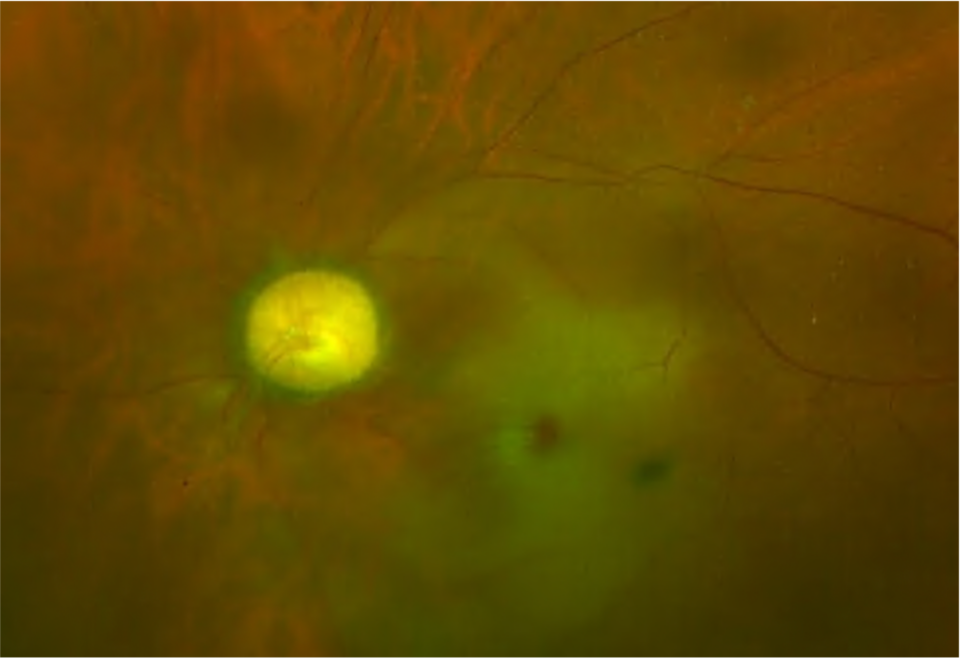 Retinal artery occlusion | Viewpoint